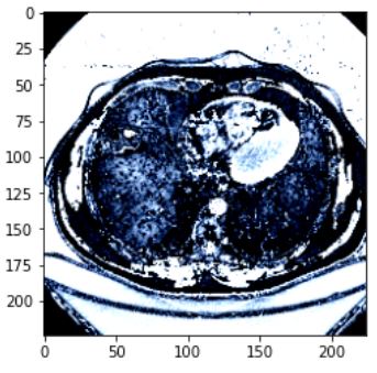 Pulmonary Embolism detection using Computer Vision | Portfolio